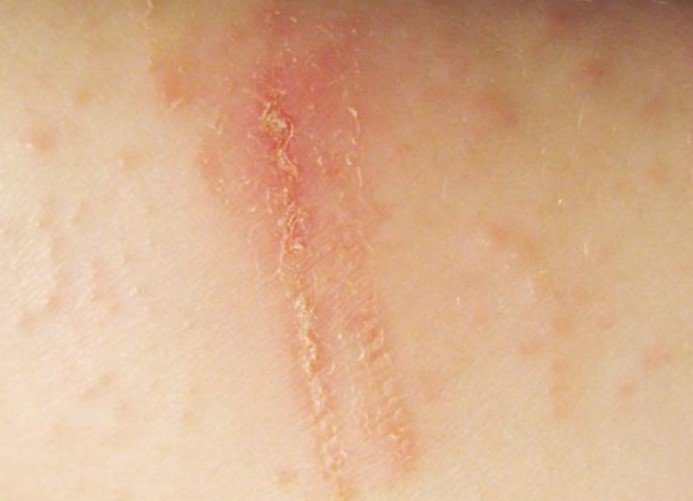 Eczema Allergy - Best Skin Specialist Clinic in Gurgaon
